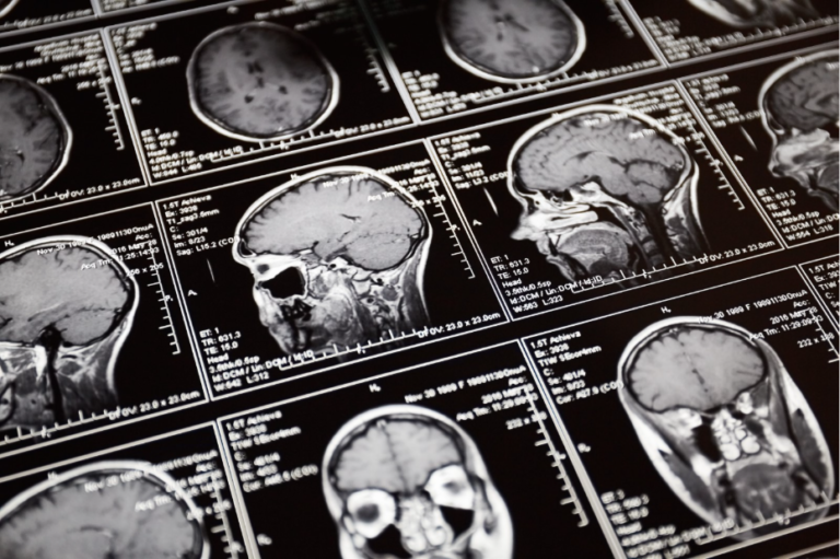 Benign vs Malignant Brain Tumours: UK Patient Guide