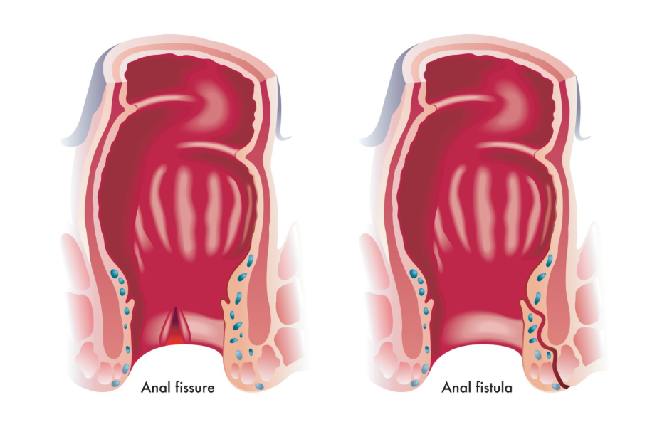 Chronic Anal Fissures: Causes, Symptoms and Healing