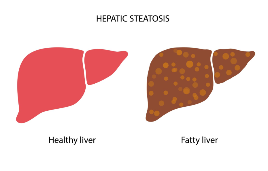 Exercise and Fatty Liver Disease Progression Risks